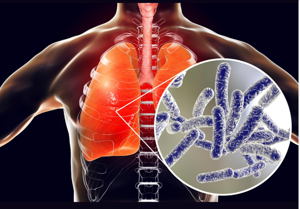 What is Legionellosis? | Medicategory.com